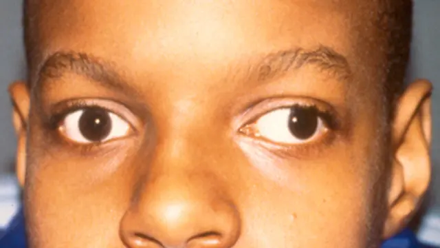 Penyebab dan Penanganan Mata Juling pada Anak, Panduan Lengkap untuk ...