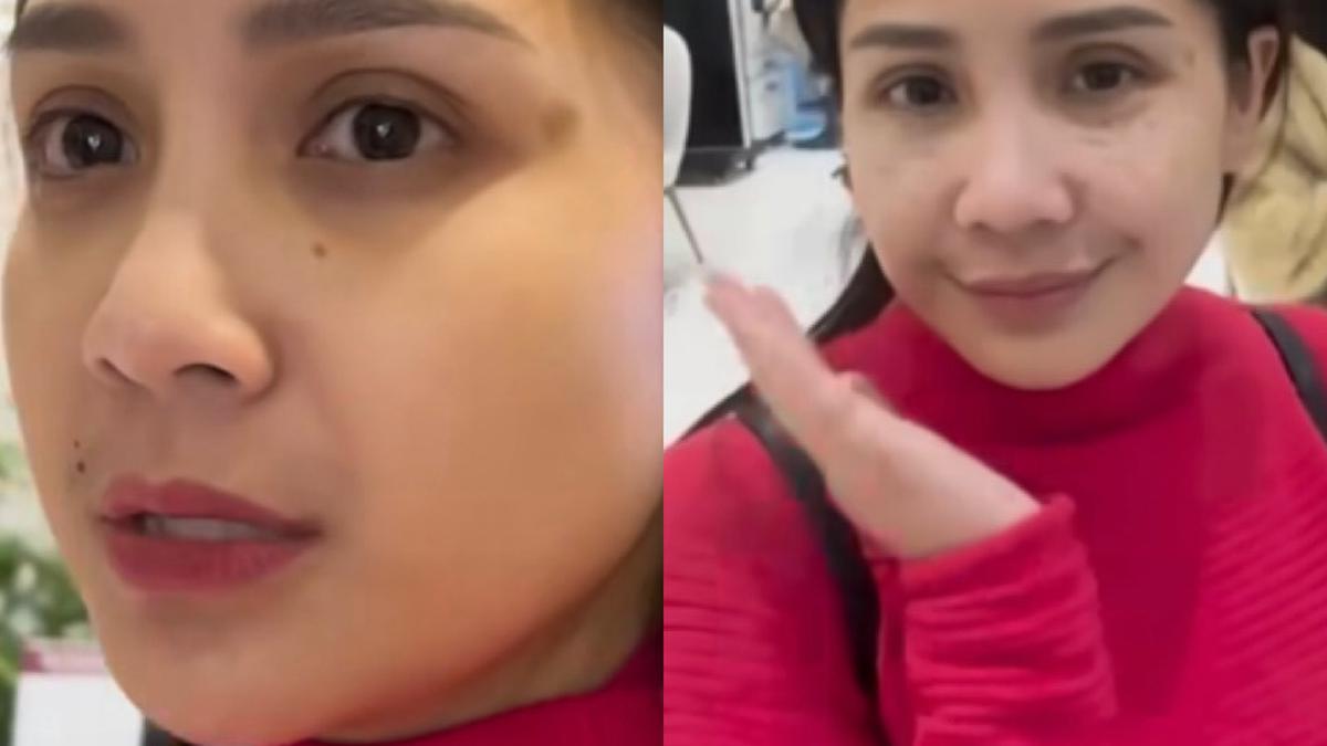 Tampilan Wajah Bengkak Nagita Slavina Setelah Perawatan di Klinik ...