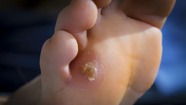 12 Cara Mengobati Mata Ikan, Dengan Garam Hingga Batu Apung - Hot Liputan6.com