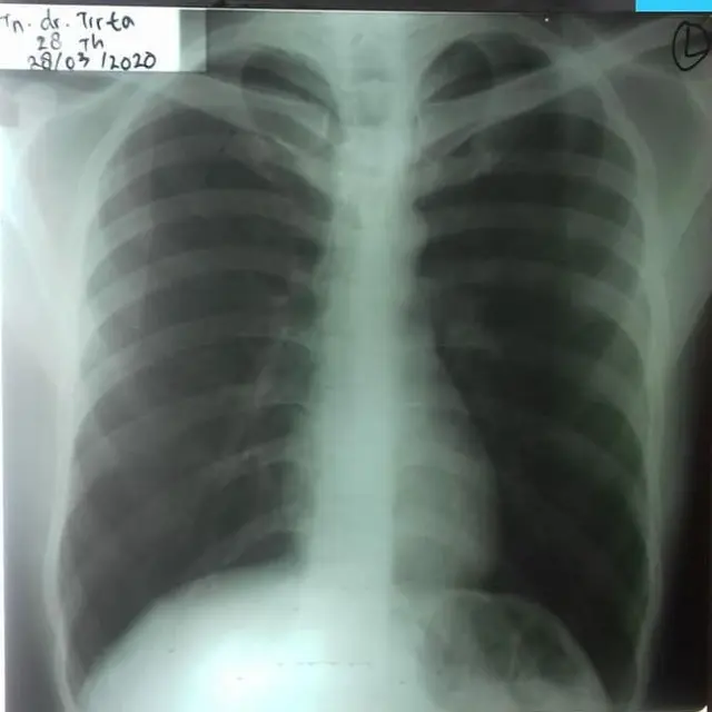 Rontgen Adalah Proses Diagnosis dengan Radiasi Sinar-X, Simak Prosedur dan Efek Sampingnya - Hot ...
