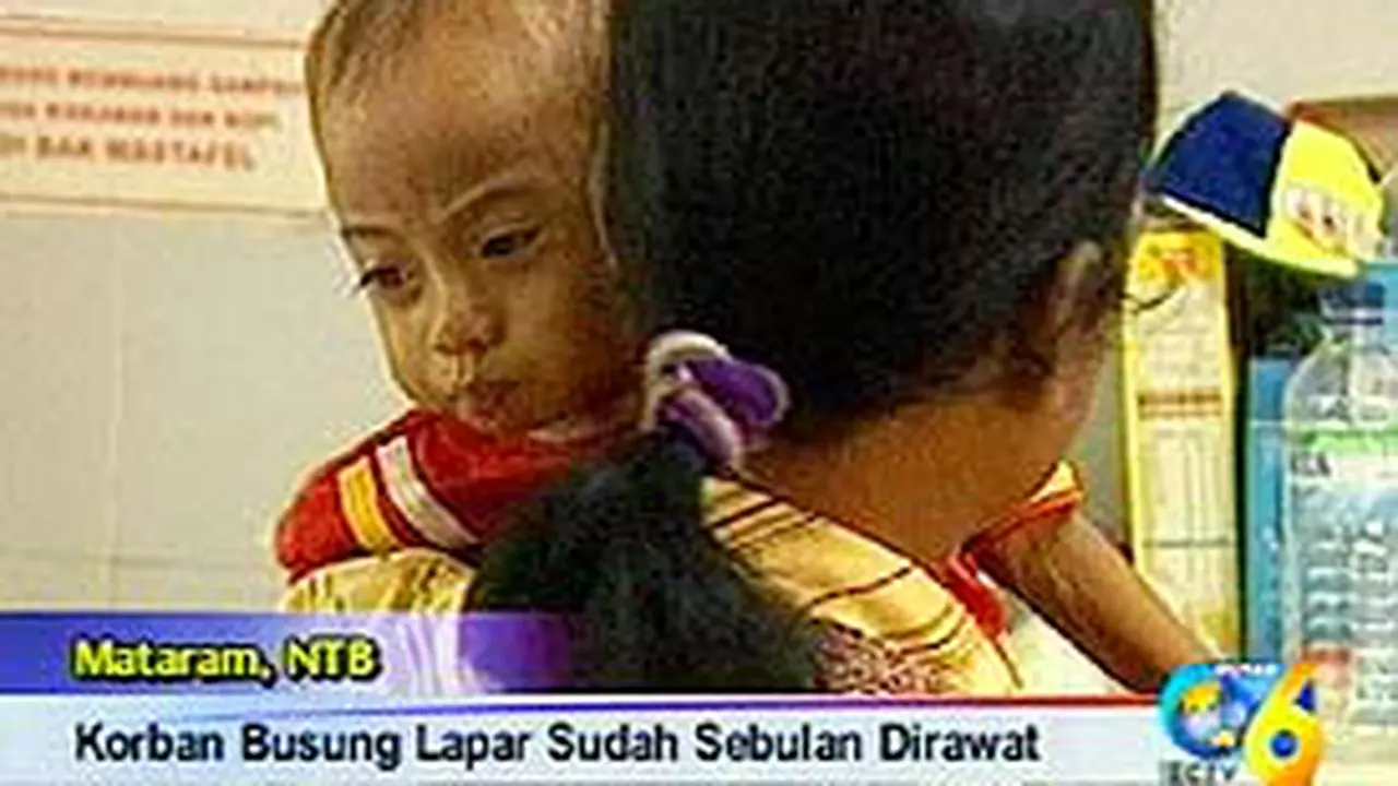 Penderita Busung Lapar di Mataram Sulit Disembuhkan - News Liputan6.com