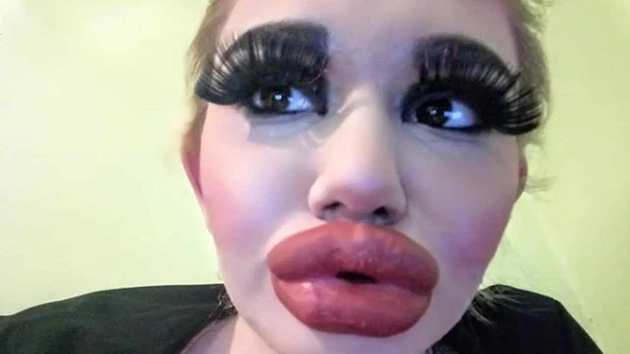Obsesi Miliki Bibir Terbesar di Dunia, Wanita Ini Lakukan Injeksi 17 ...