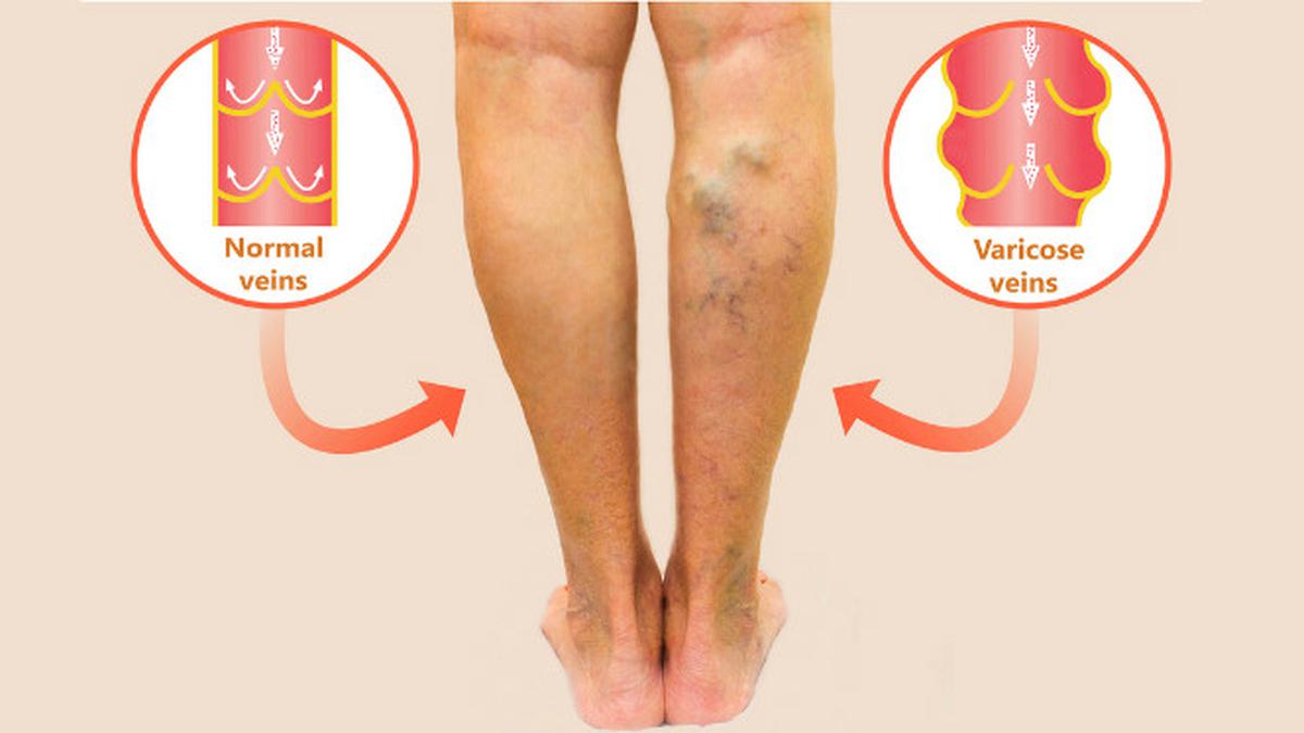 Kupas Tuntas Seputar Penyakit Varises - Health Liputan6.com