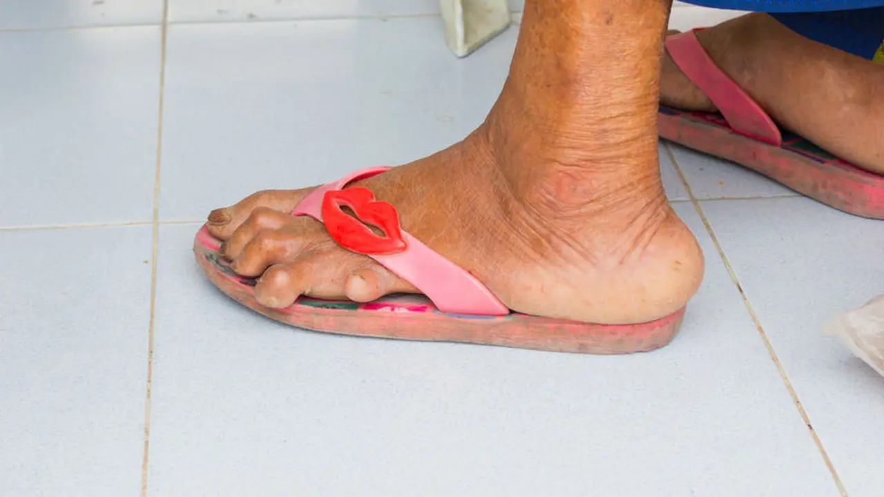 4 Penyebab Penyakit Kusta, Gejala, Jenis serta Cara Pengobatan yang ...