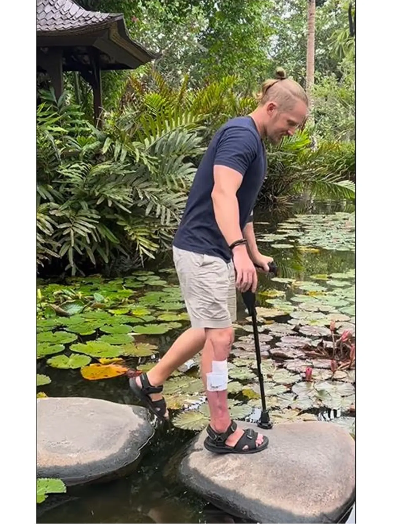 6 Potret Terkini Daood Debu Pasca Kecelakaan dan 5 Kali Operasi, Sudah Bisa Jalan - Hot Liputan6.com