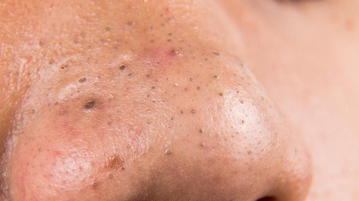 8 Bahan Alami untuk Membasmi Komedo Hitam yang Mengganggu - Citizen6 ...