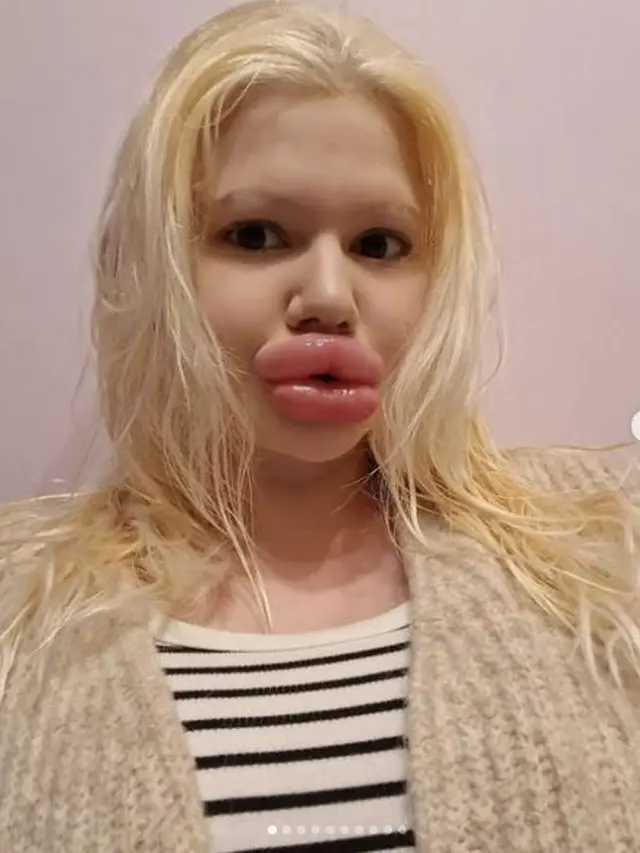 6 Foto Terkini Andrea Ivanova Wanita Viral Pemilik Bibir Terbesar, Kini ...