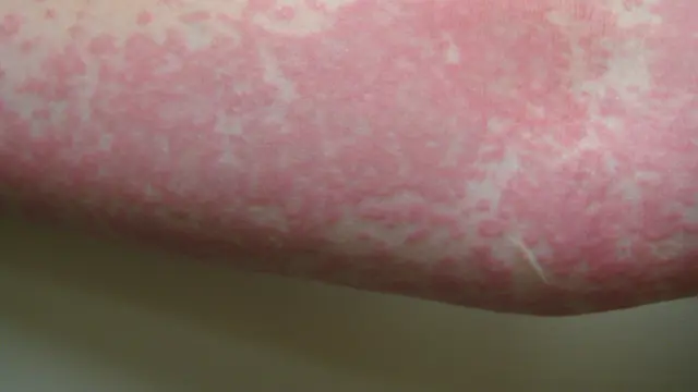 Gejala Biduran dan Penyebabnya, Serta Cara Mengatasinya yang Tepat ...