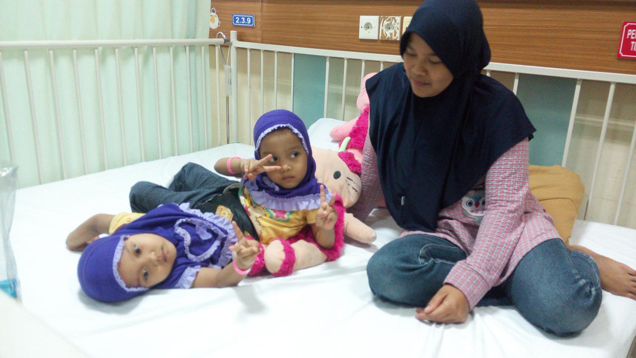 Kisah Kelahiran Kembar Siam Berkaki Tiga Asal Garut