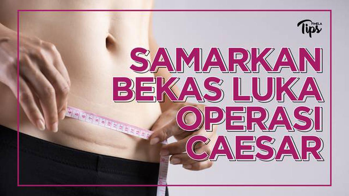 4 Cara Merawat Bekas Luka Operasi Caesar