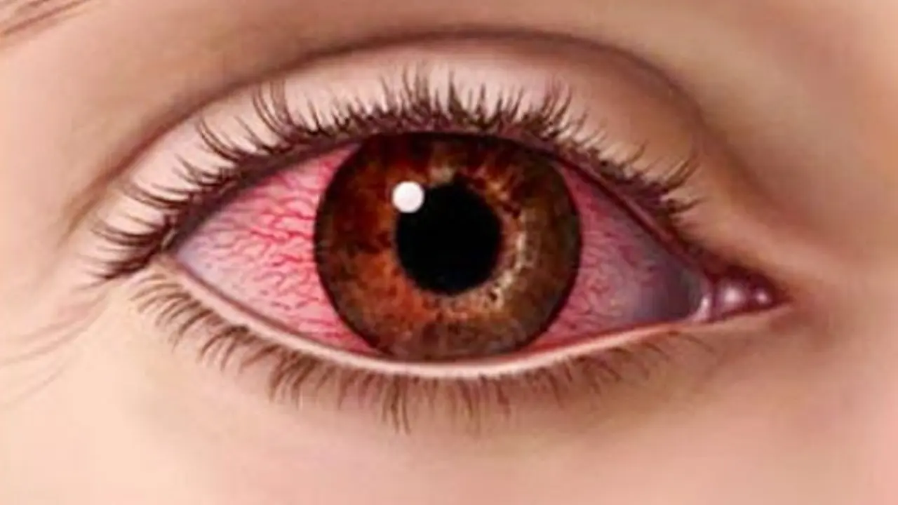 7 Penyebab Mata Bengkak dan Cara Mengatasinya - Hot Liputan6.com