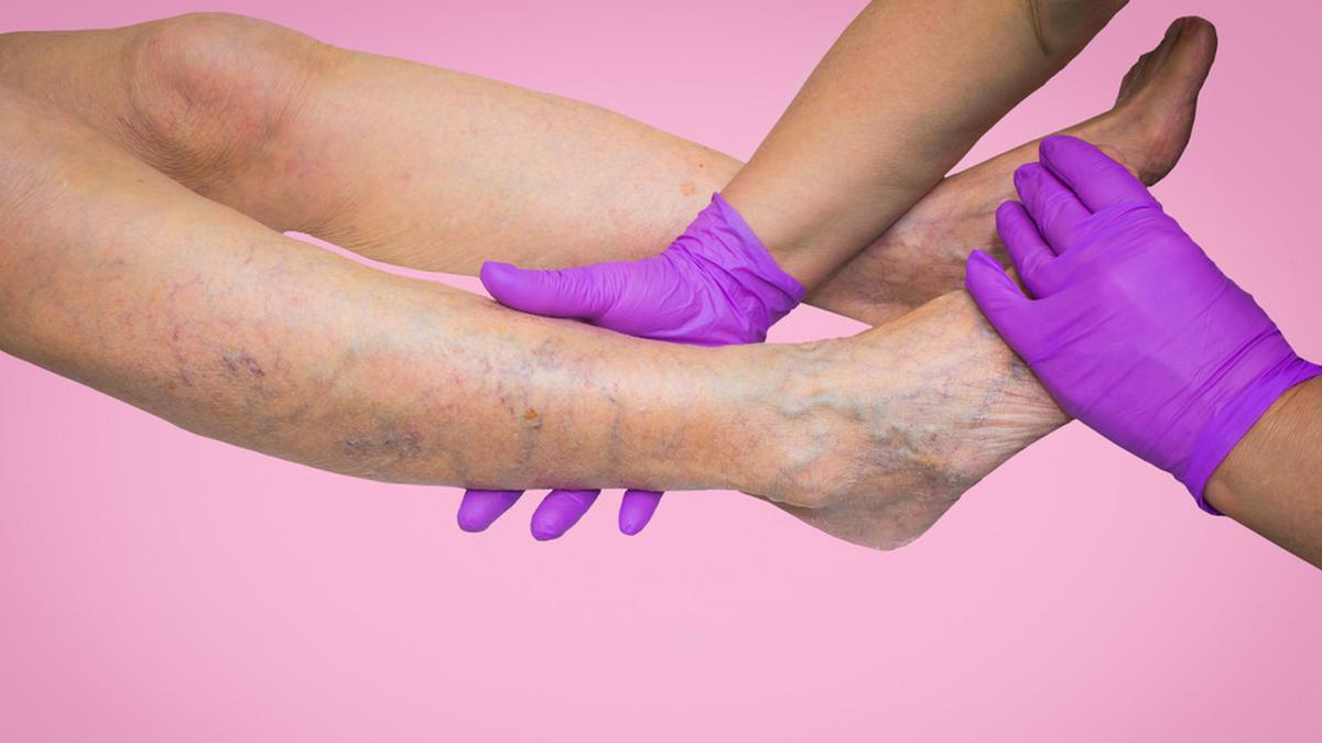 Mengenal Varises Vena: Penyebab, Tingkat Keparahan dan Cara Pengobatan