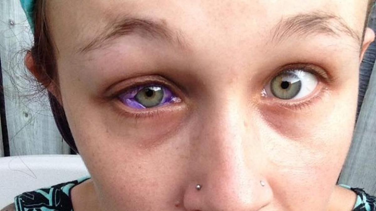 Coba Tato Bola Mata, Cewek Ini Nyaris Buta