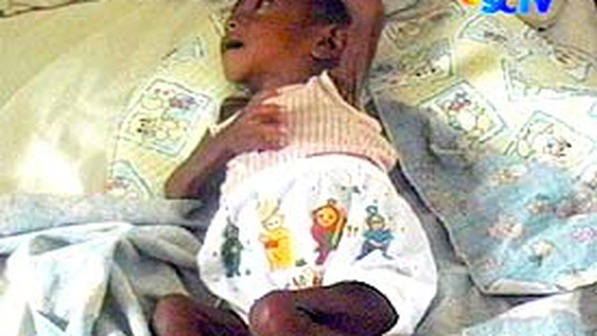 Pemprov NTT Menyiapkan Dana untuk Busung Lapar - News Liputan6.com