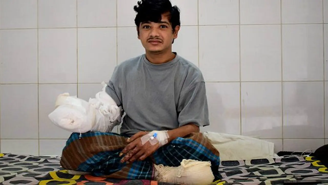 Kutil "Manusia Pohon" Bangladesh Kembali Tumbuh - Health Liputan6.com