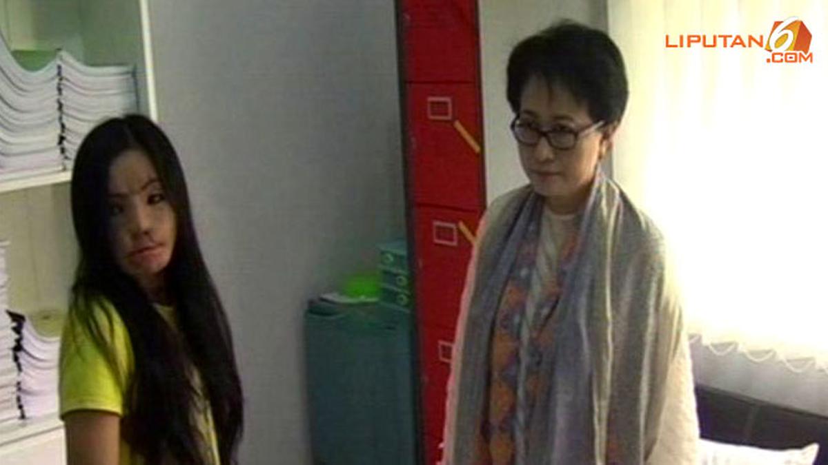 VIDEO: Lisa Face Off akan Operasi Permak Wajah ke-17 - Health Liputan6.com