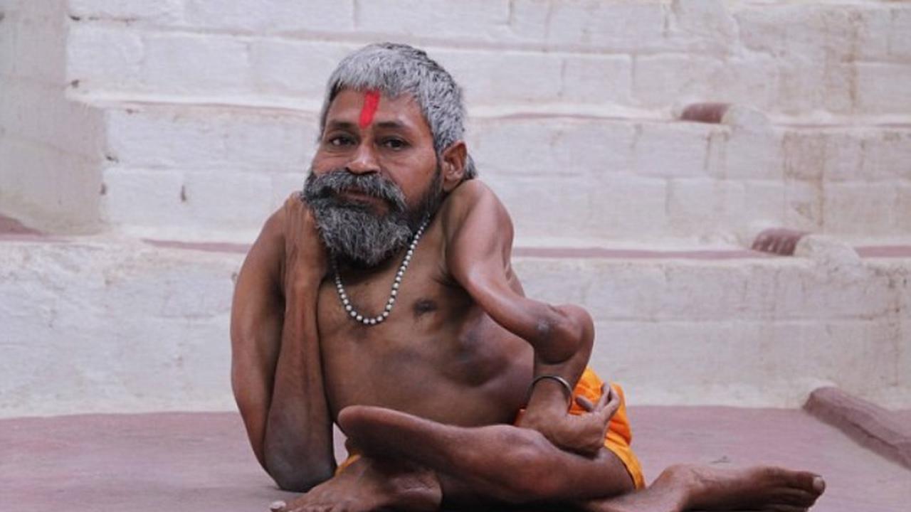 Penyakit Misterius Buat Tulang Tubuh Pendeta India Membengkok