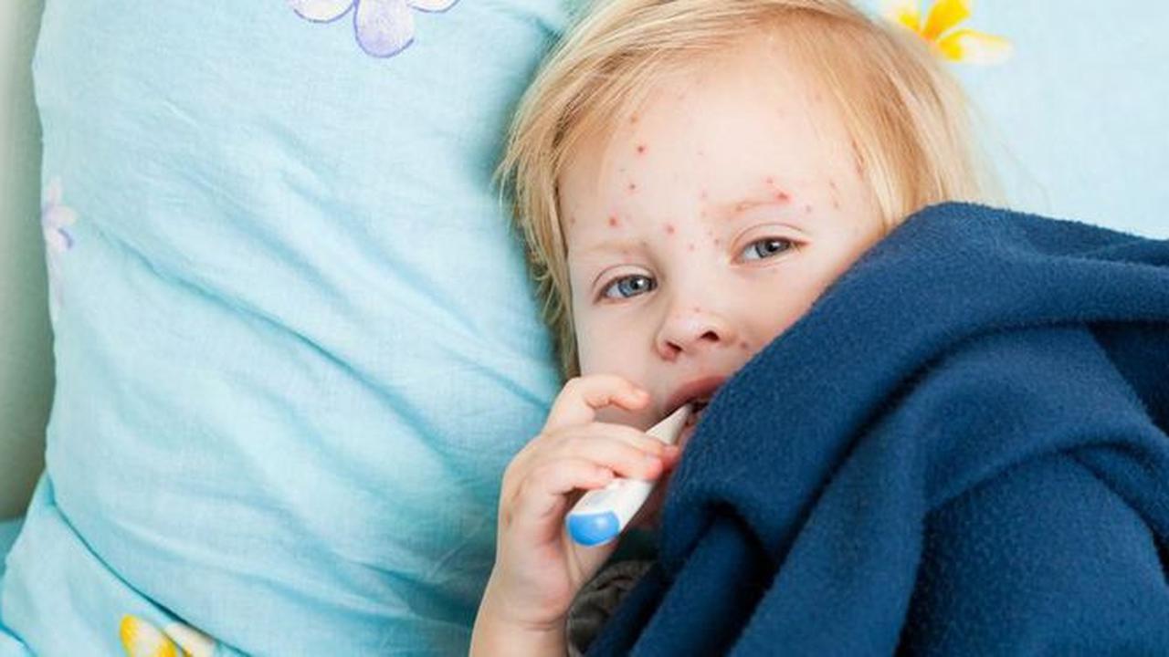 Morbili Adalah Penyakit Infeksi Menular, Kenali Gejala dan Penyebabnya