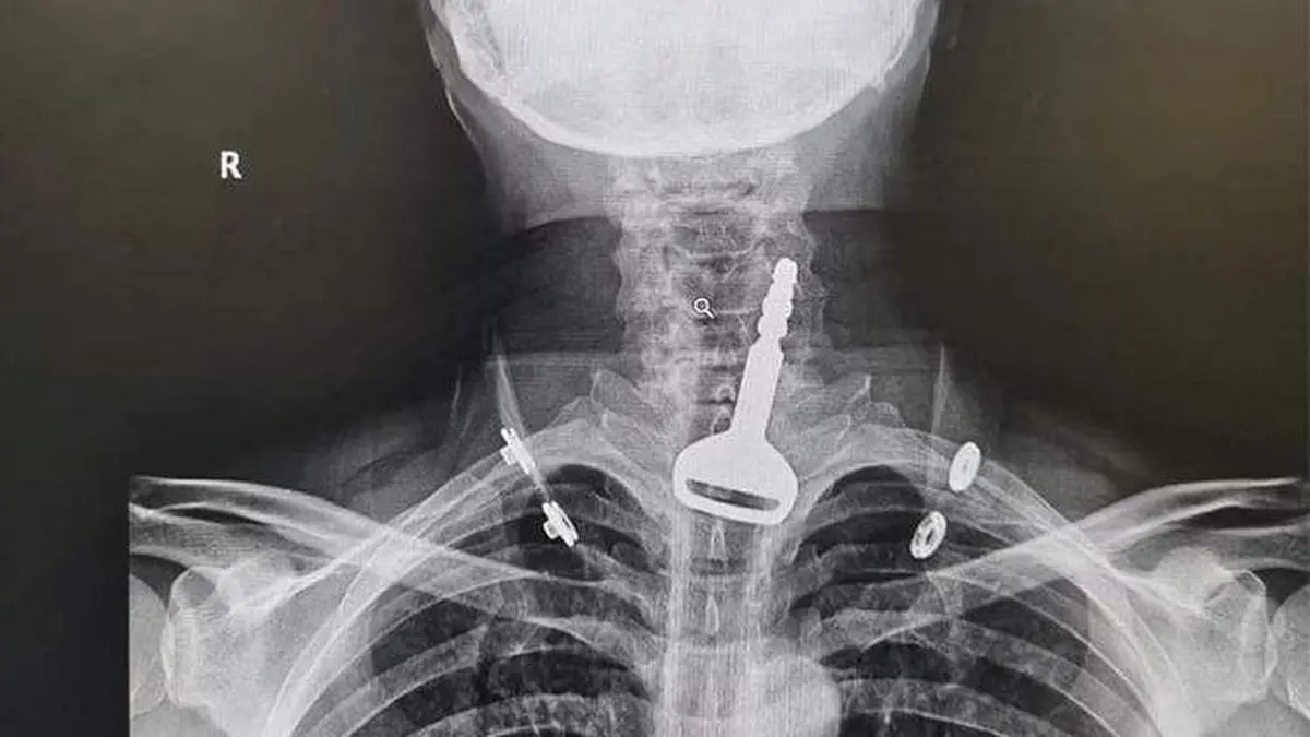 Berita rontgen adalah Hari Ini - Kabar Terbaru Terkini | Liputan6.com