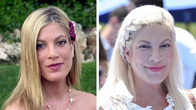 10 Penampilan Artis Hollywood Berubah Drastis Usai Operasi Plastik ...