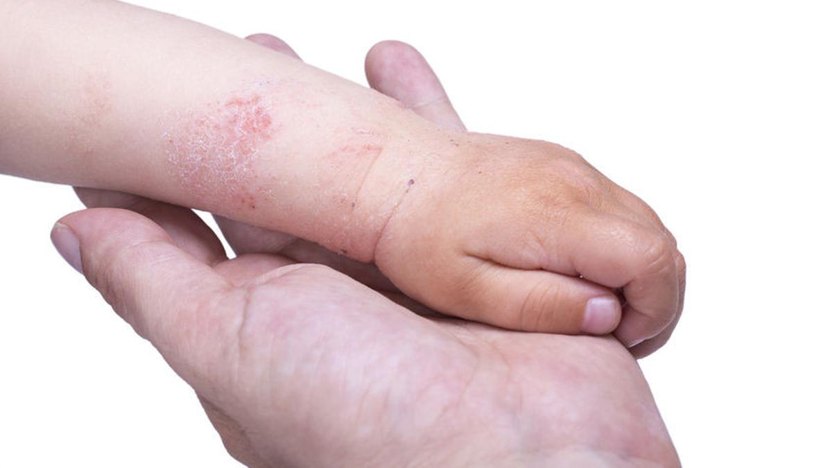 Mengenal Macam-macam Dermatitis, Apa Saja Penyebabnya?