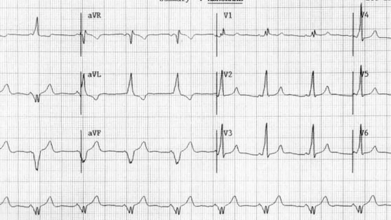 9 Cara Membaca EKG untuk Pemeriksaan Jantung, Pahami Tahapannya - Hot ...