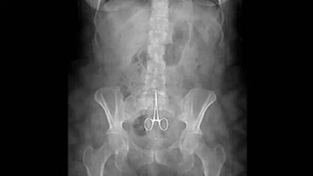 4 Foto Rontgen Ini Bikin Ngilu, Ada yang Tertancap di Kepala - Citizen6 ...