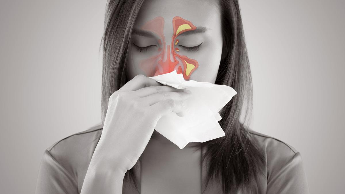 Apa Itu Sinusitis? Kenali Gejala, Penyebab, dan Cara Mengatasinya - Hot ...