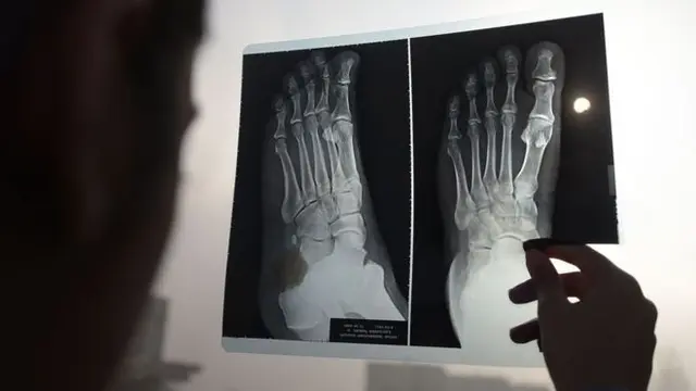 Rontgen Adalah Proses Diagnosis dengan Radiasi Sinar-X, Simak Prosedur ...