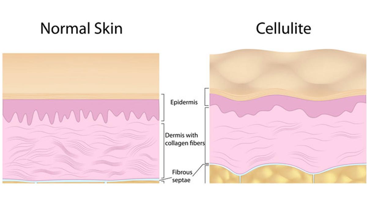 Kulit Selulit Hukuman Seumur Hidup - Health Liputan6.com