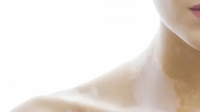 Mengenal Penyakit Panu yang Menular, Penyebab, Gejala dan Cara ...