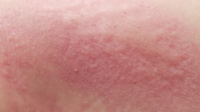 8 Jenis Ruam yang Bisa Menjadi Tanda COVID-19 - Health Liputan6.com