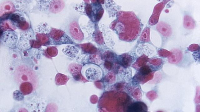 Mengenal Infeksi Amuba Pemakan Otak yang Mematikan, Gejala dan Cara ...