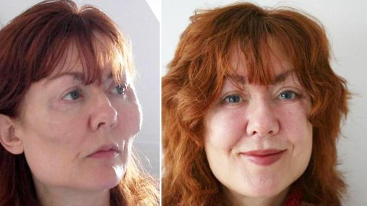 Akibat Operasi Plastik Wajah Jadi Berantakan dan Tersisa Penyesalan ...