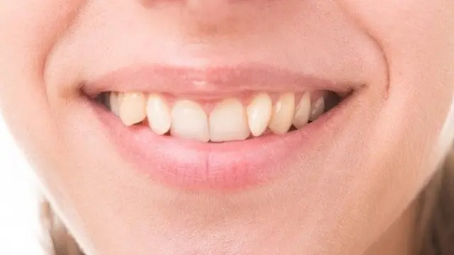 Gigi Gingsul hingga Tubuh Gemuk, Ini 7 Standar Kecantikan Tidak Lazim ...