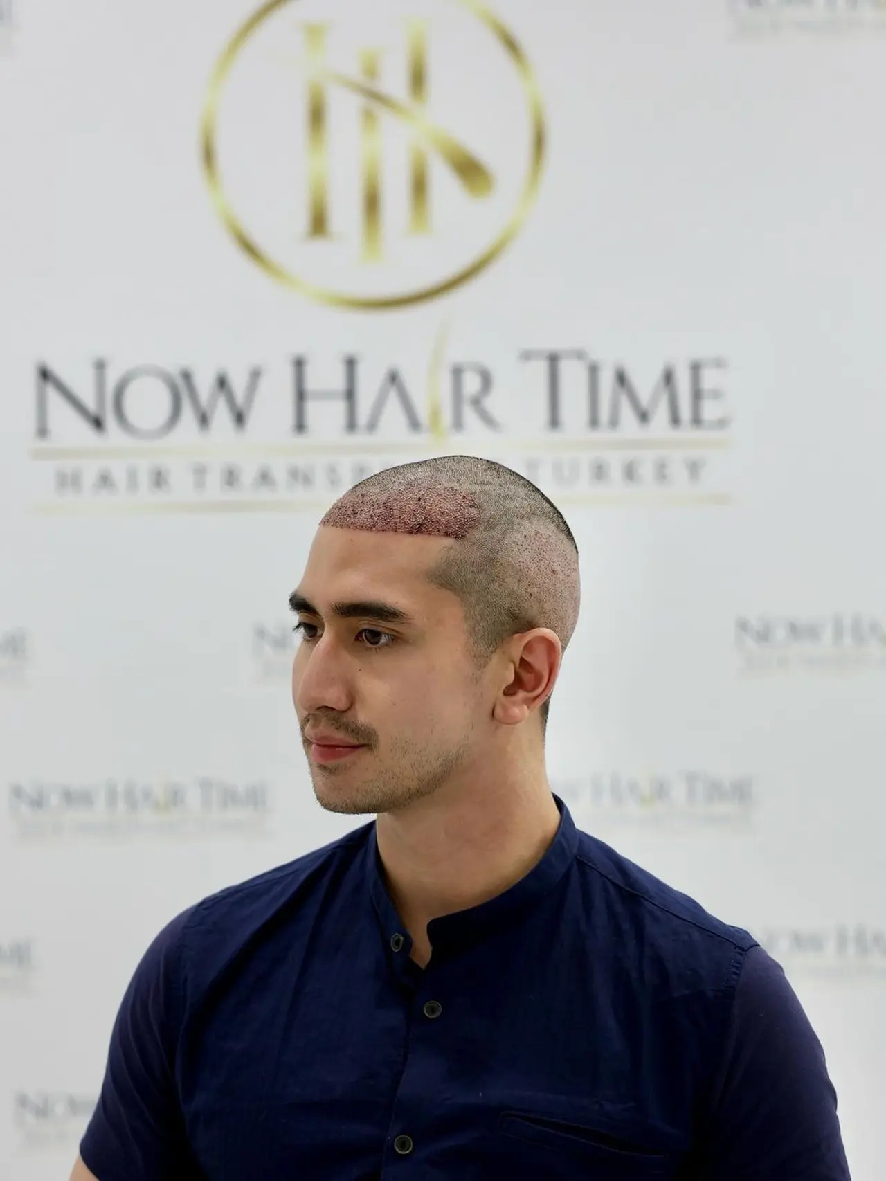 Proses Verrel Bramasta Lakoni Tanam Rambut, Dibotakin dan Digambar Dulu ...