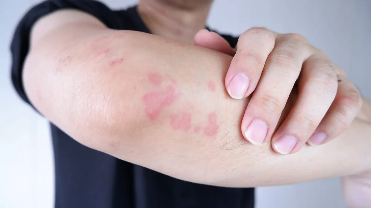 Ketahui Penyebab, Gejala, dan Penanganan Stevens-Johnson Syndrome (SJS ...