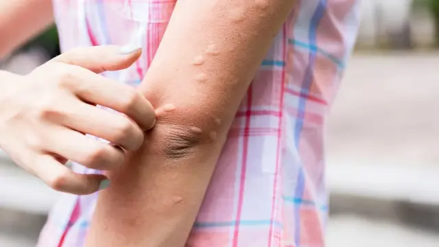 17 Jenis Gatal pada Kulit dan Gambarnya, Umum Diderita Semua Usia - Hot ...