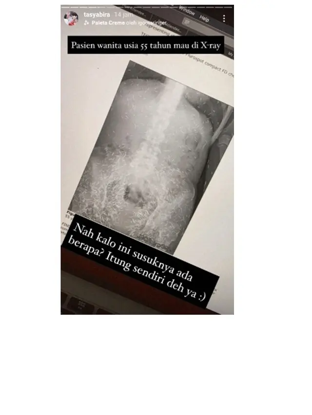Viral Foto X-Ray Wanita dengan Ratusan Jarum Diduga Susuk, Bikin Heboh Netizen - Page 2 - Hot ...