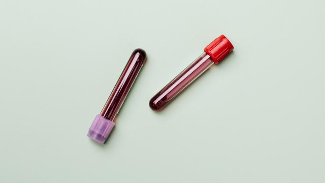 D-dimer adalah Pemeriksaan untuk Mendeteksi Masalah Pembekuan Darah ...