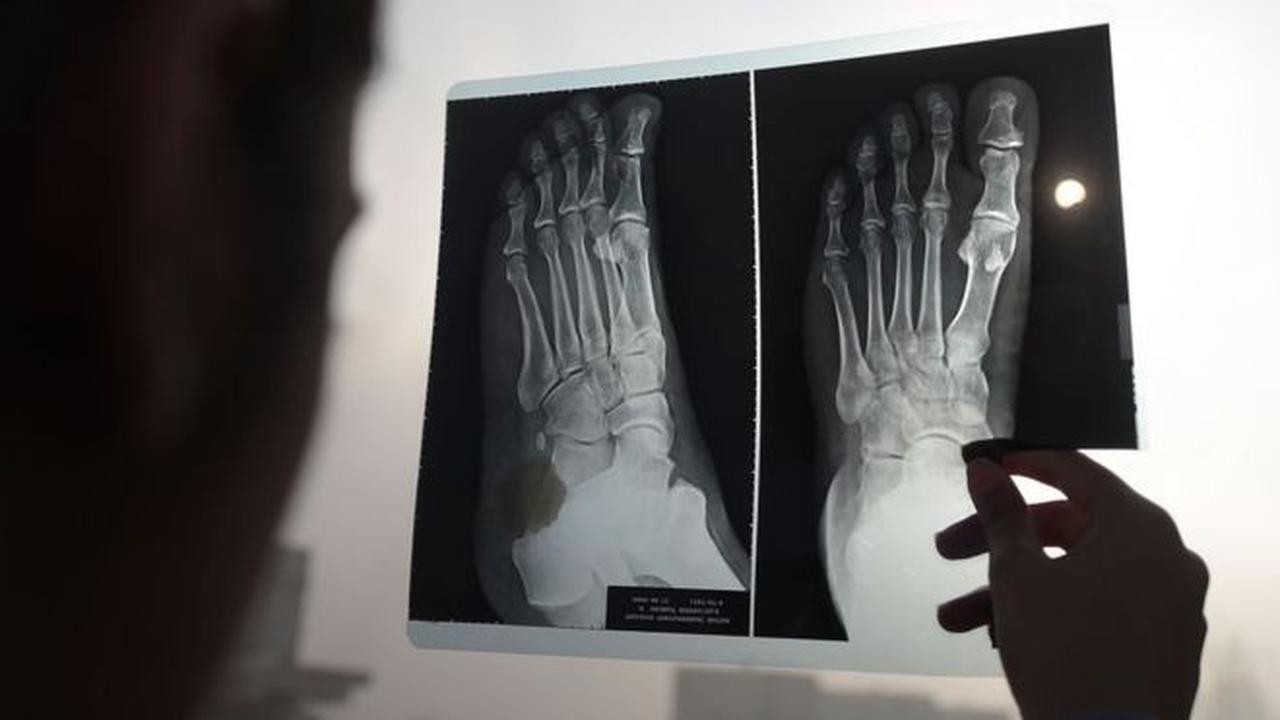 Rontgen Adalah Proses Diagnosis dengan Radiasi Sinar-X, Simak Prosedur ...