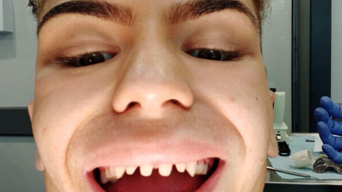Pria Ini Habiskan Rp57 Juta Ikut Tren Veneer Gigi di Turki, Hasilnya ...