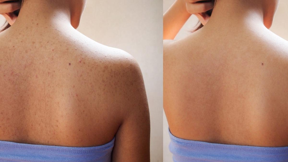 Penyebab Jerawat Punggung dan Cara Mengatasinya - Beauty Fimela.com